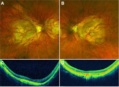 Figure 1 From Cataract Surgery In The Setting Of Severe Pathologic