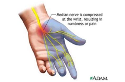 Depressor Nerve Nerve Problem
