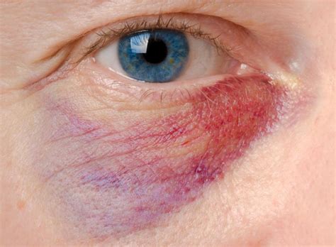 What Are Allergic Shiners With Pictures