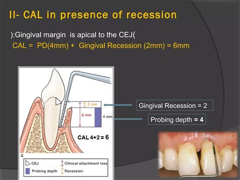 Periodontal Examination And Diagnosis Ppt
