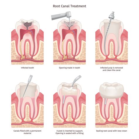 Root Canal Diagram