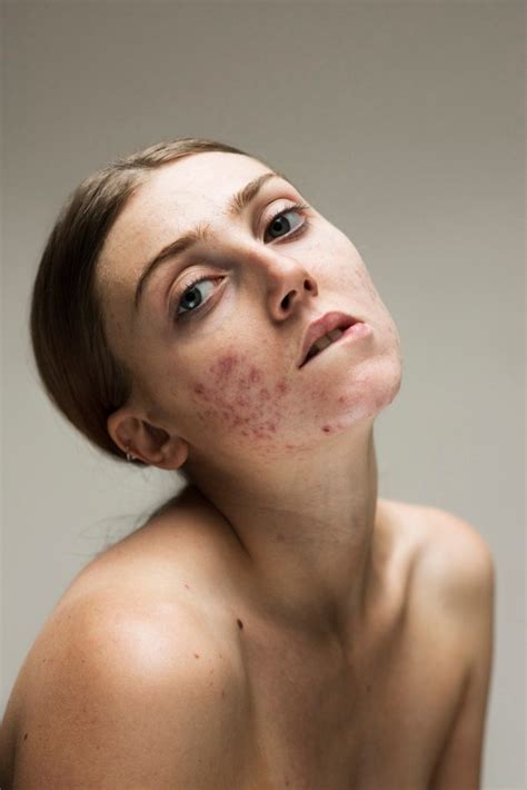 Portraits Of Peoples Skin Conditions Celebrate The Beauty Of
