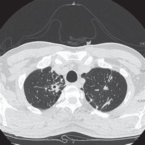 Figure Computed Tomography Image Of Chest Of Patient With Tuberculosis Download Scientific