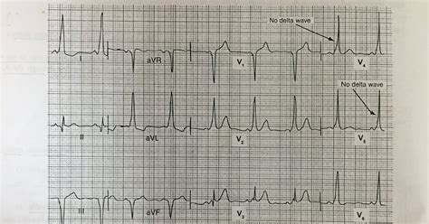 Ecg Lgl Syndrome And Sinus Arrythmia