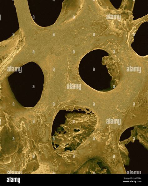 Cancellous Spongy Bone Tissue Coloured Scanning Electron Micrograph