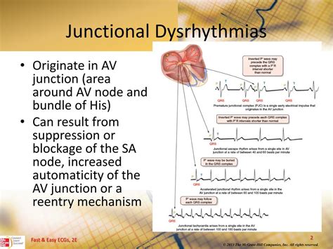 Ppt Junctional Dysrhythmias Powerpoint Presentation Free Download