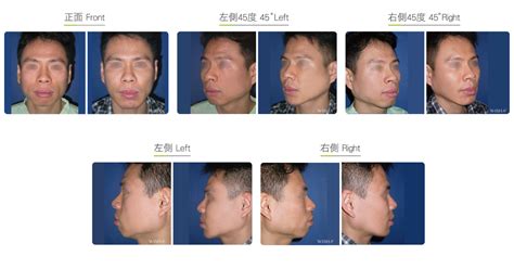 Mandible Angle Splitting Osteotomy Facial Bone Wishclinic