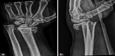 Dorsal Plating For Distal Radius Fractures A Safe And Effec Journal Of Orthopaedic