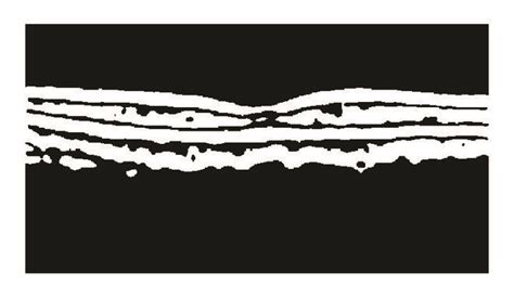 Segmented Retinal And Choroidal Layers A Highly Coherent 2d