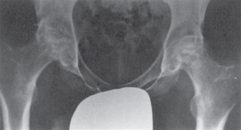 X Ray Showing Bilateral Osteonecrosis Of The Femur In Patient With Download Scientific Diagram
