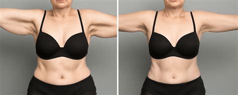 Sagging Skin How To Prevent Sagging Skin When You Lose Weight