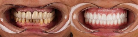 Yellow Teeth Treatment