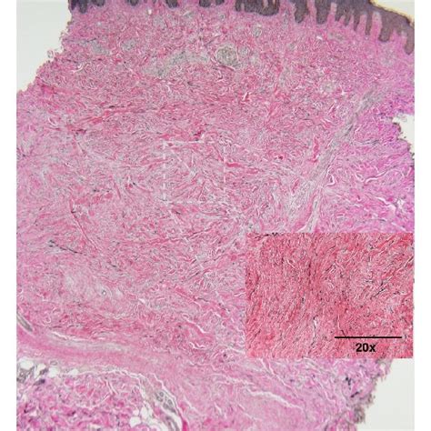 Keloidal Scleroderma Multiple Scattered And Hyperpigmented Nodules