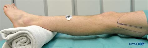 Popliteal Block Popliteal Block Sciencedirect