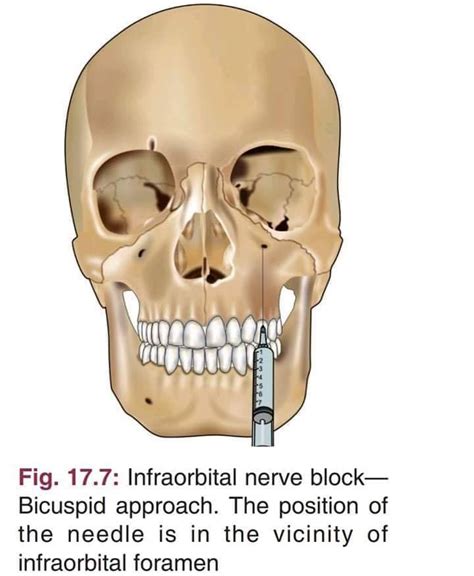 Infraorbital Nerve Block Complications