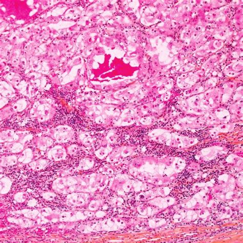 Radical Nephrectomy Specimen Demonstrating Synchronous Pelvic