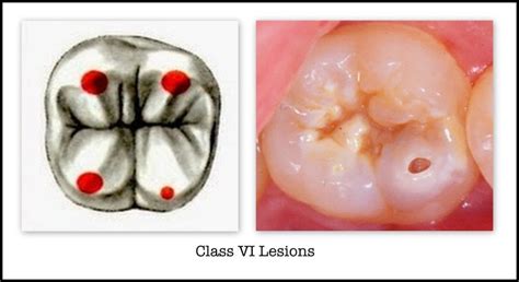 What Is Tooth Decay And Its Types Ilajak Medical