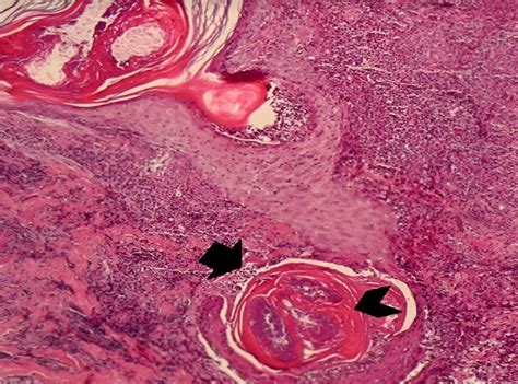 การอักเสบจากแผลใต้สิว Wound Inflammation Doodee Precision