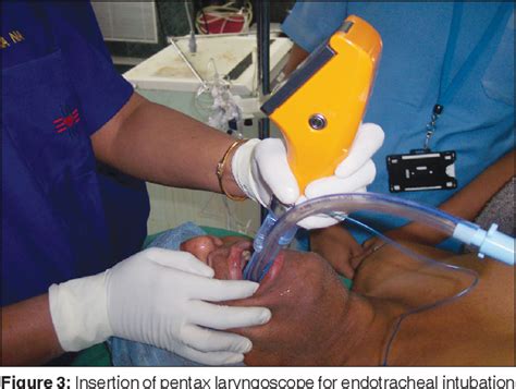Laryngoscopy Assisted Endotracheal Intubation At Myrtle Jackman Blog
