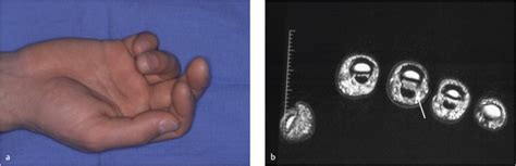 Bowstringing Musculoskeletal Key
