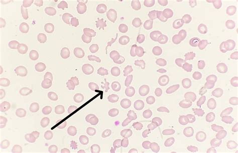 Forme Normal Et Anormale De Globules Rouges
