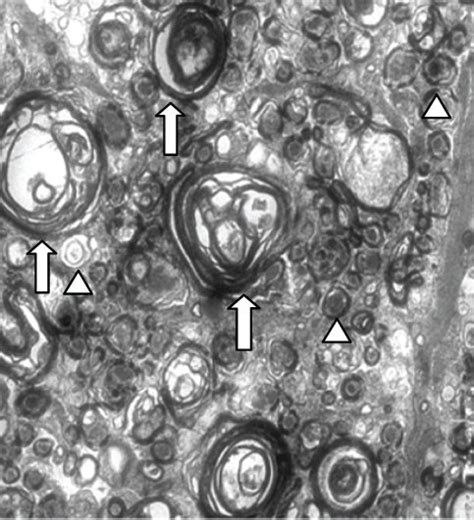 Myelin Content Within The Optic Nerve Ad Mbp Labeling Green Two