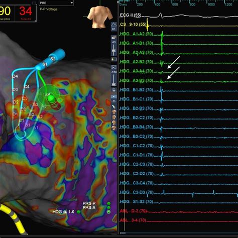 Top Panel Shows Geometry And Voltage Map Of Left Atrium In Posterior