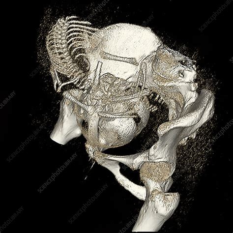 Pelvimetry Ct Scan Stock Image C0353642 Science Photo Library