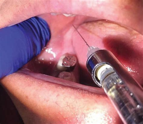 Enhancing Mandibular Block Anesthesia Dimensions Of Dental Hygiene
