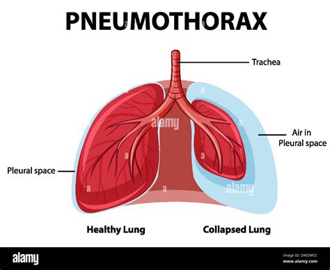 Schéma Pneumothorax Avec Poumon Collabé Et Poumon Sain Image Vectorielle Stock Alamy