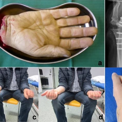 Case Two Subtotal Amputation Of The Forearm A Preoperative Picture