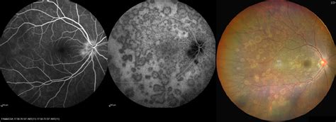 Indocyanine Green Icg Angiography Treatment And Management Point Of