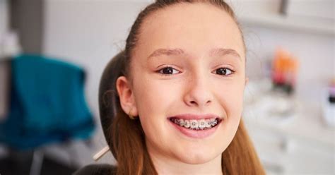 Tipos De Brackets ¿cuáles Hay Y En Qué Se Diferencian