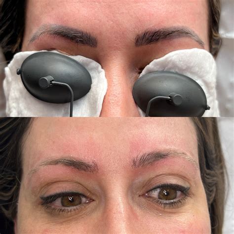 Laser Microblading Removal Sian Dellar