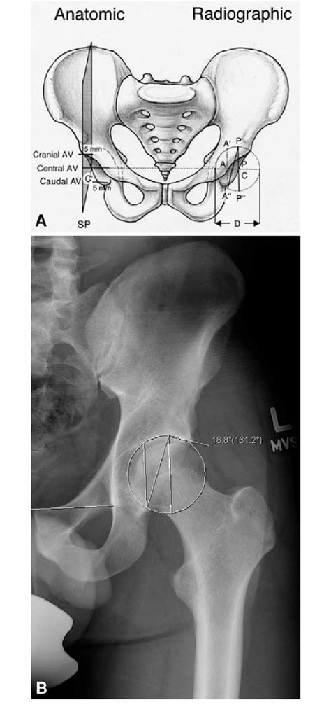 A B A A Line Drawing Demonstrates Measurement Of Acetabular Version