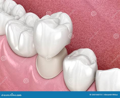 Preparated Premolar Tooth And Dental Crown Placement Medically