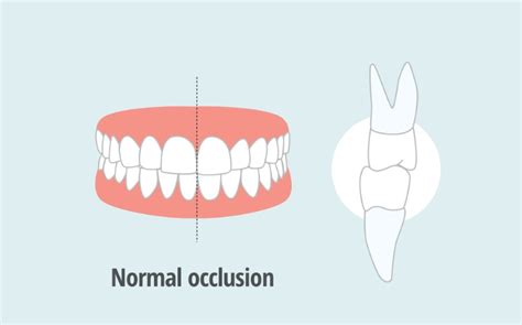 Overbite Vs Normal Bite Differences Symptoms And Treatments