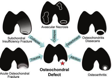 Figure 2 Osteochondral Lesions Of The Knee