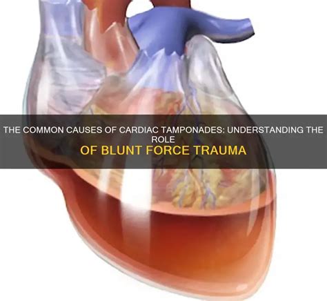 The Common Causes Of Cardiac Tamponades Understanding The Role Of