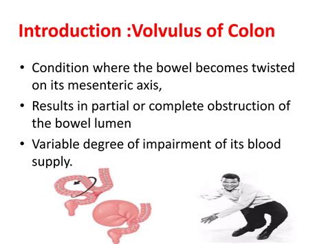 Volvulus Of Colon Pptx