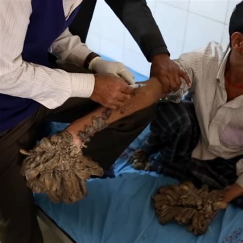 Hpv Tree Man Jpeg Nature Animals And Random Fun Facts Abul