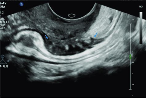 Ustvbp Image Showing A Longitudinal Section Of The Rectosigmoid