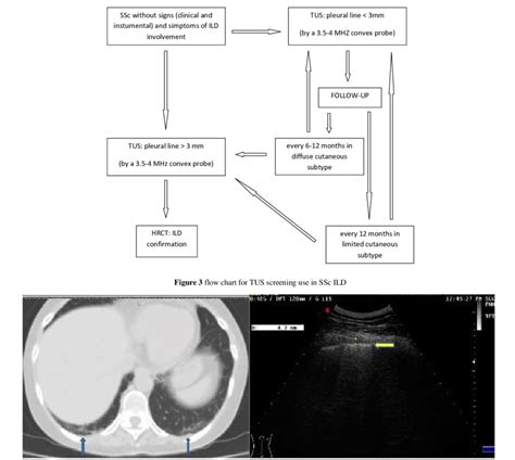 A Reticular Nodular Hrct Pattern Limited To Basal Area And