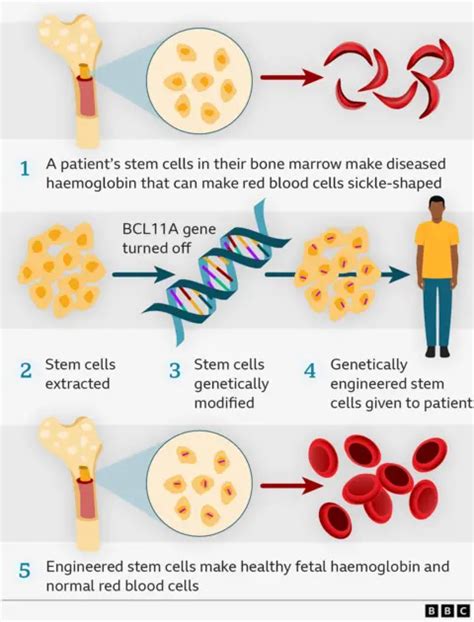 Nhs To Offer Groundbreaking Sickle Cell Gene Therapy