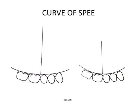 Full Mouth Rehabilitation Using Pankey Mann Schulyer Technique Pptx