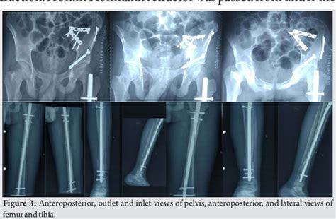 Figure 3 From A Rare Case Of Ipsilateral Floating Ileum” With Floating Hip And Floating Knee