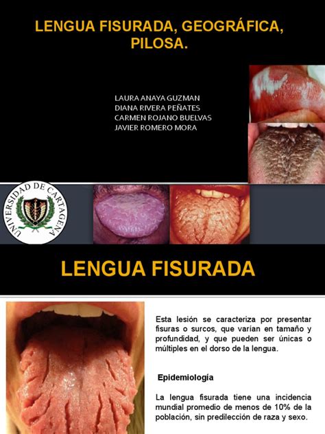 Lengua Fisurada Y Geográfica Causas Y Tratamiento Pdf Medicina