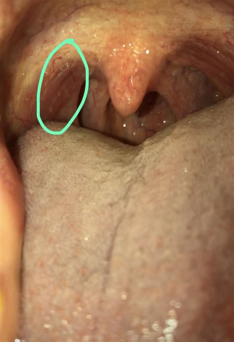 Are These White Spots Tonsils Stones Help Me Out Rtonsilstones