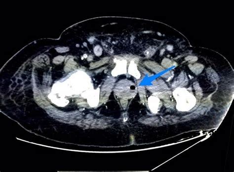Ct Cross Sectional View Showing Air In The Prostate Gland Download