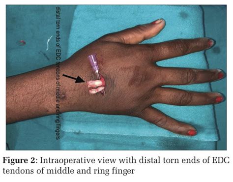An Unusual Mode Of Extensor Tendon Injury A Case Report